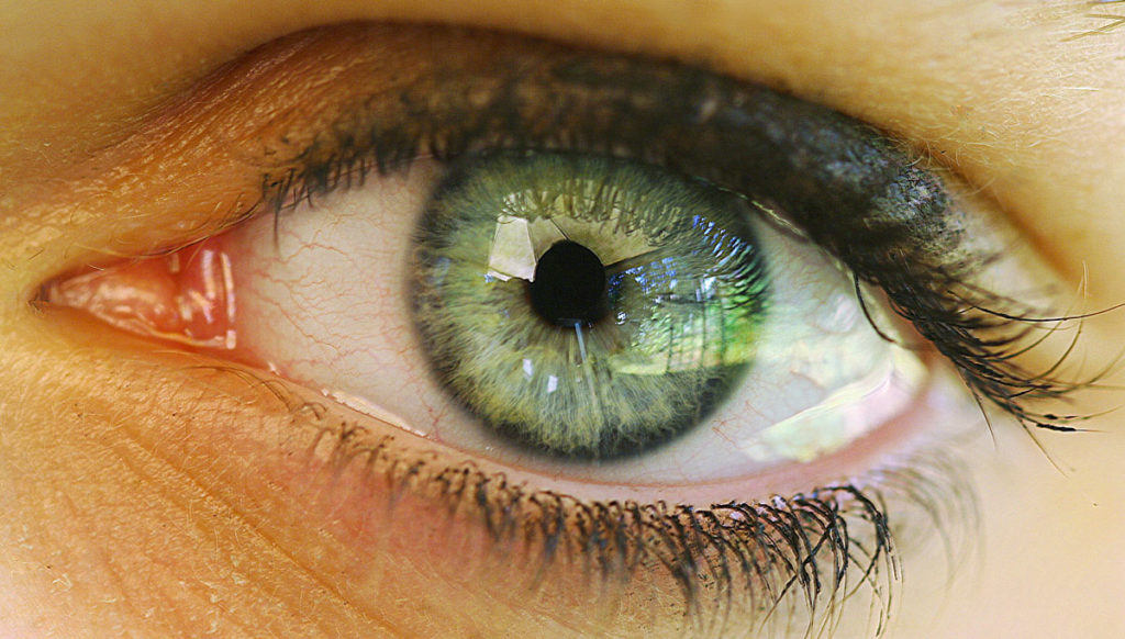 Pterigion: Carnocidad a los ojos - Clínica Peruana de la Visión Clinica ...